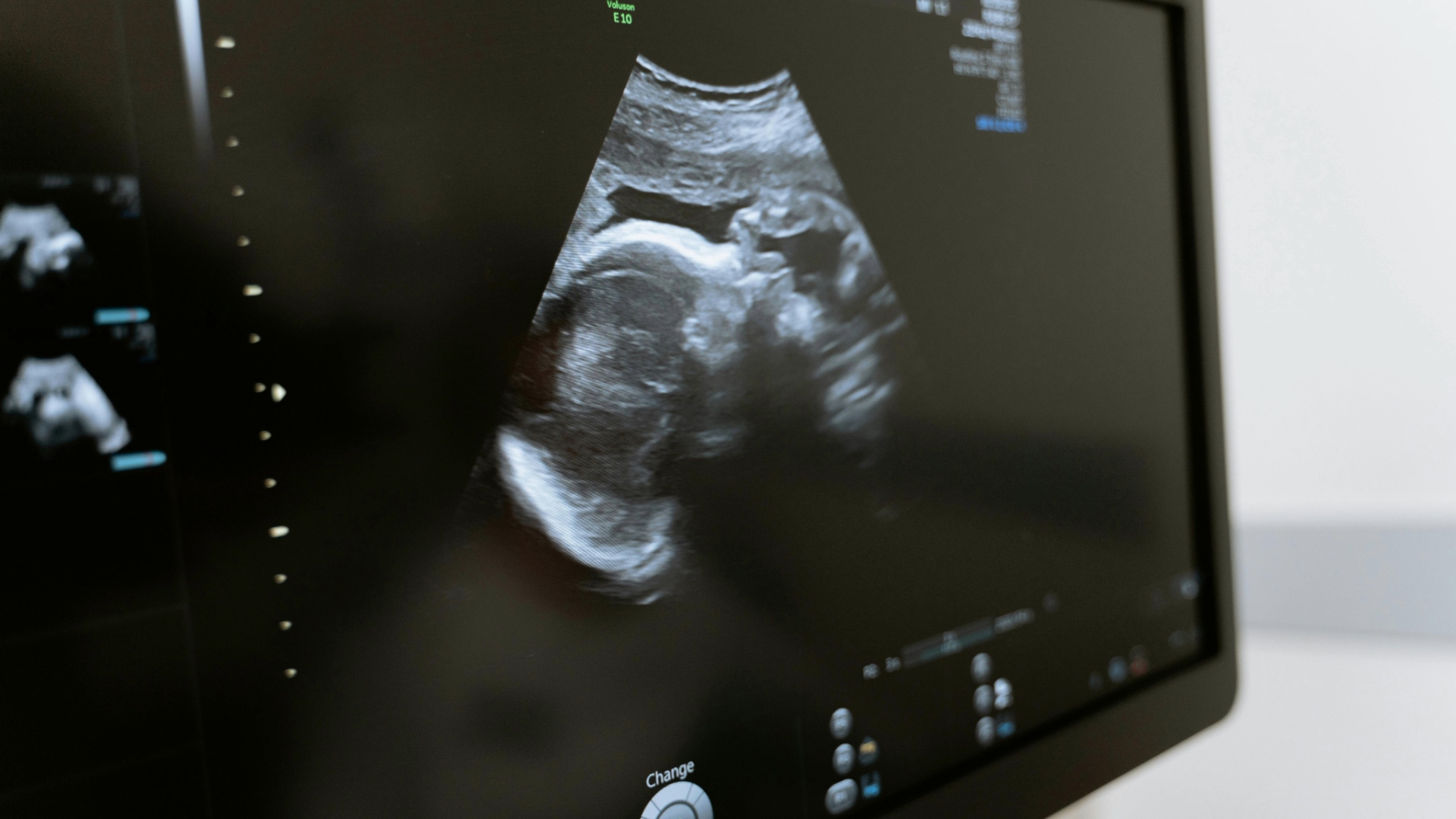 Natera Expands Prenatal Testing Panel to Cover 20 Inherited Conditions ...